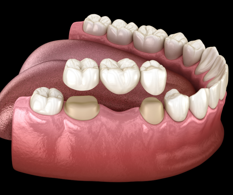 Bridges & Composite Bonding - Lans Family Dentistry