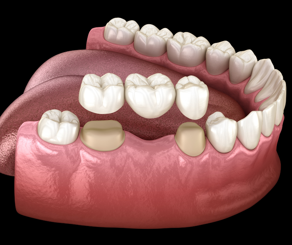 Dental Bridge