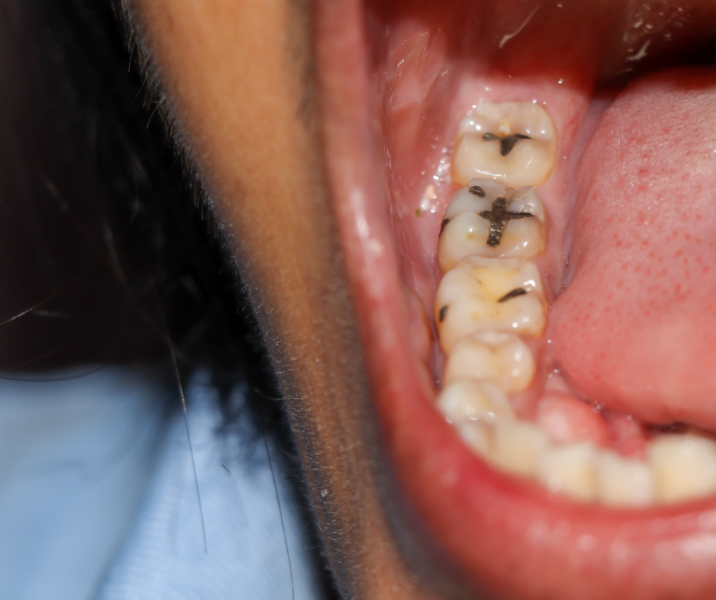 Understanding Cavities: Causes and Prevention - Lans Family Dentistry