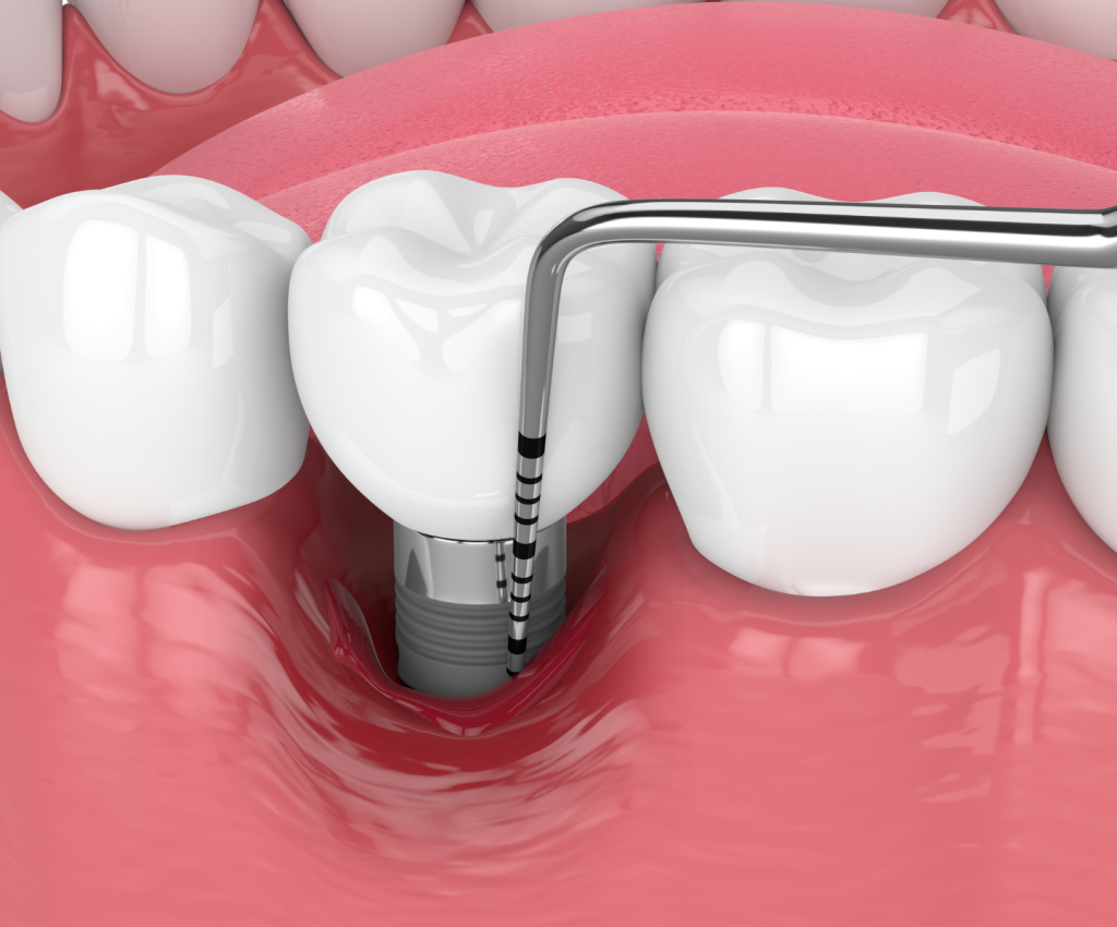 Understanding Periodontal Therapy - Lans Family Dentistry
